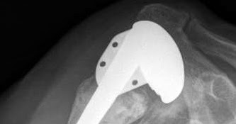 UW Shoulder and Elbow Academy: Reverse total shoulder - progressive ...