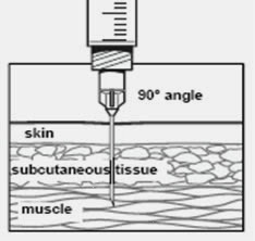 Kebidanan: Macam-macam Injeksi