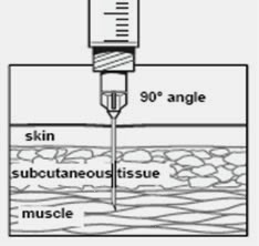 Kebidanan: Macam-macam Injeksi
