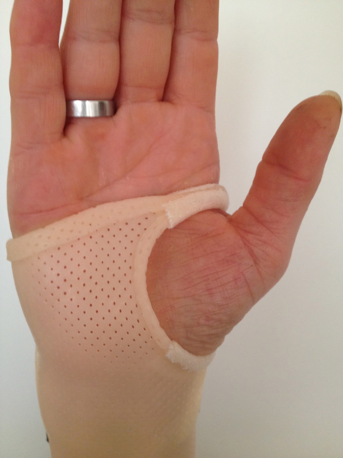 Orthèses sur mesure et appareillage personnalisé main poignet doigts ...