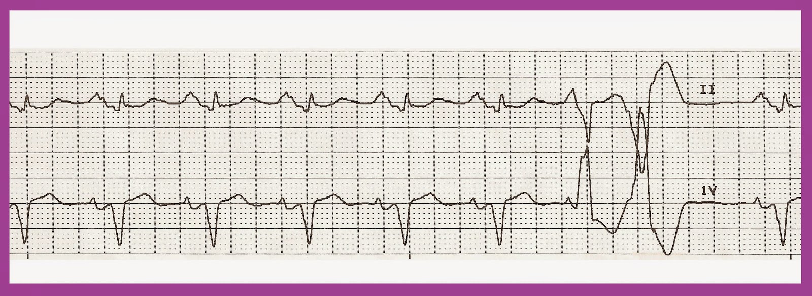 Basic EKG Rhythm Test 19