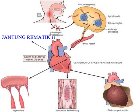 Penyebab Demam Rematik dan Jantung Rematik Serta Pengobatannya ...