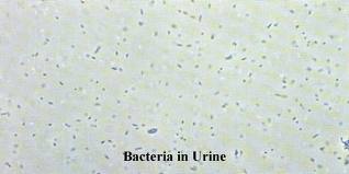 MICROSCOPIC URINALYSIS