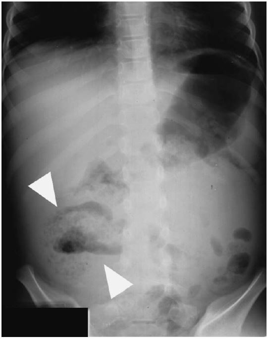 Chronic Appendicitis Symptoms Treatment And Outlook