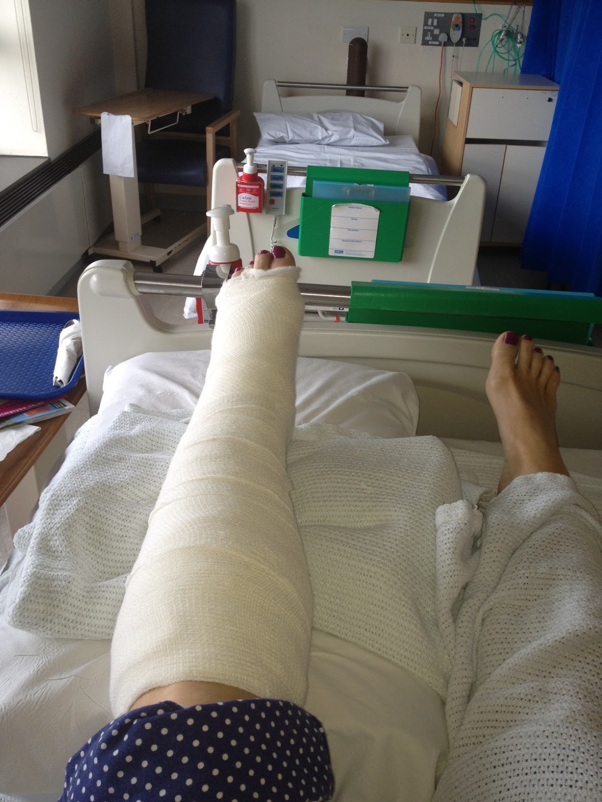 From Cornwall to Crutches - Trimalleolar Fracture: April 2012