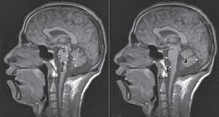 Medical Treatment Pictures-for Better Understanding: Machado-Joseph Disease