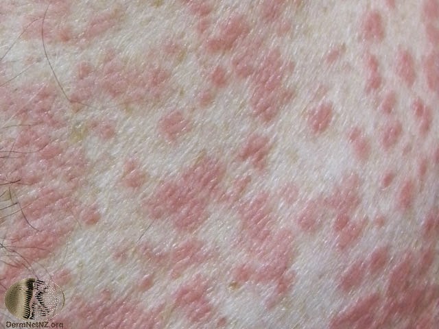 Prezentari Medicale: Mononucleoza infectioasa (MNI)