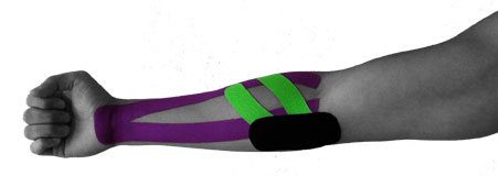 ARES Kinesiology Tape: Golf Elbow