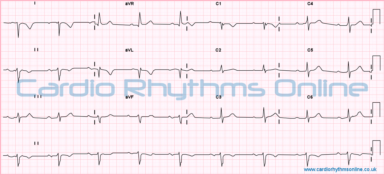 CVT Mohd Farid: ECG Basic:Cardiac Axis-Credit Cardio Rhythm Online Blogspot
