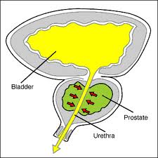Yuk Bisnis Kecantikan: Penyakit Prostat