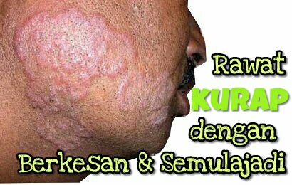 Cara Merawat Kurap dengan Berkesan dan Semulajadi - Serimuslimah Sihat