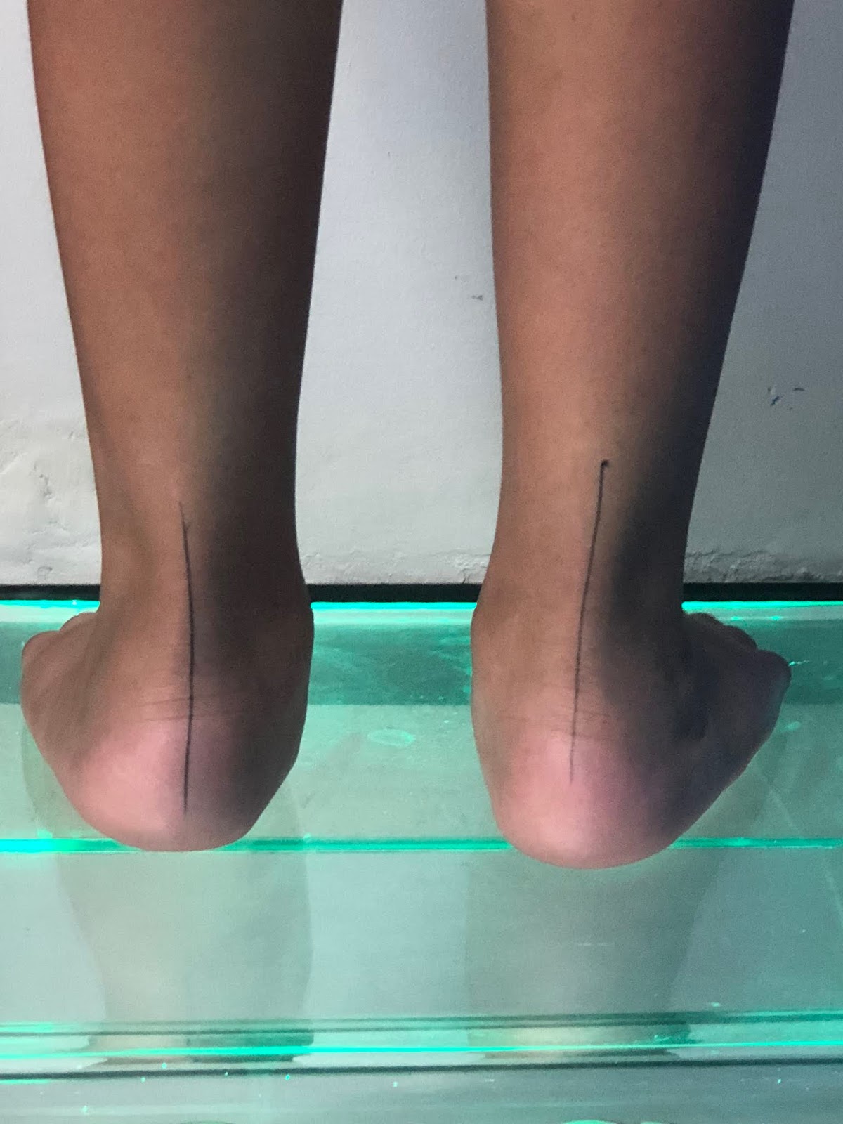 Dr Zeluis Gómez Podiatra: Pie plano valgo flexible infantil