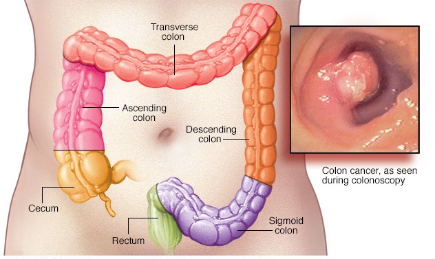 7 Early Warning Signs Of Colon Cancer Most People Miss 7-early-warning-signs-of-colon-cancer-most-people-miss
