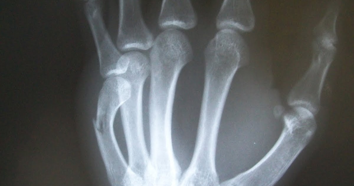Boxer’s Fracture | Boxer Bone Fracture Treatment | Surgery