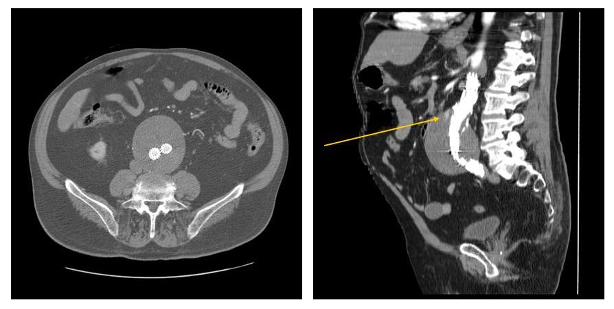The Pump and the Tubes: Arc of Riolan / "meandering mesenteric artery"