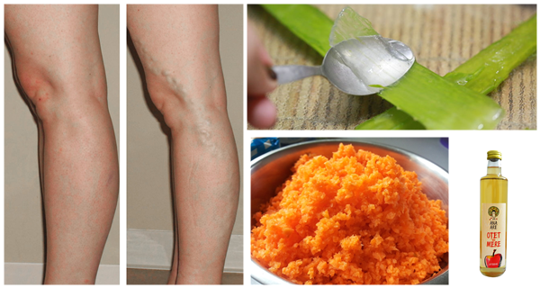 Pentru Suflet: Cel mai eficient tratament pentru varice!