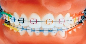 Lo Nuevo Esta Aquí. : 9 tips para portadores de brackets