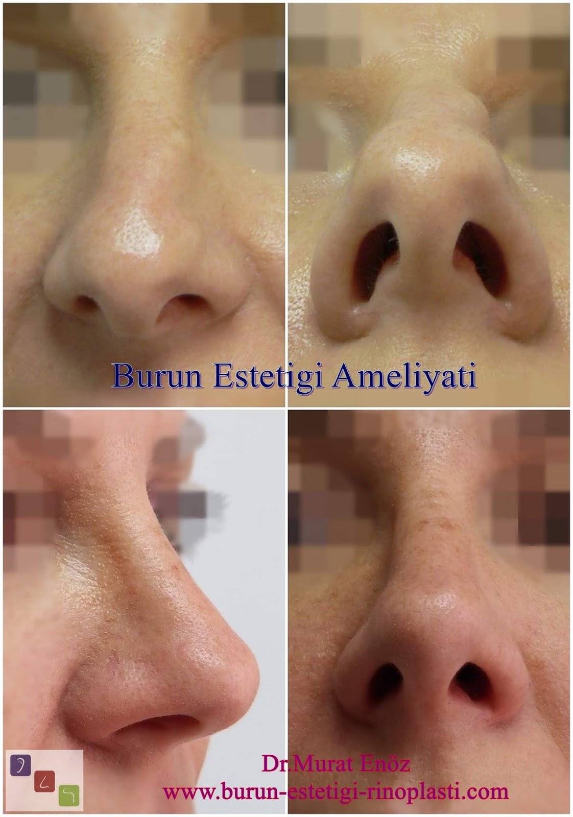 Burun Estetigi (Rinoplasti)