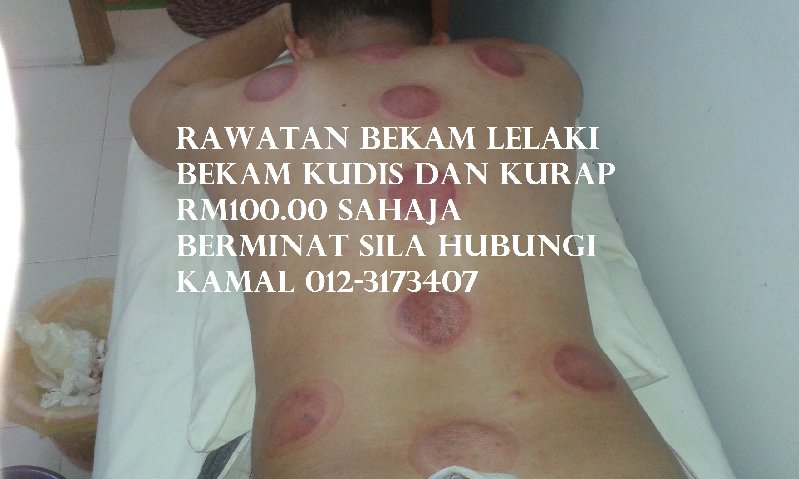 Bekam: BEKAM KUDIS DAN KURAP