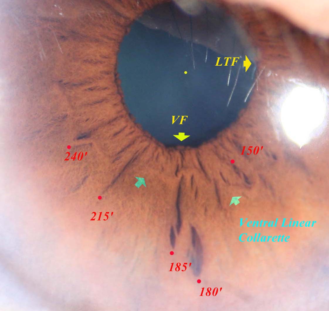 Modern & Multidimensional Iridology: Pupil Flattenings, Embryological ...