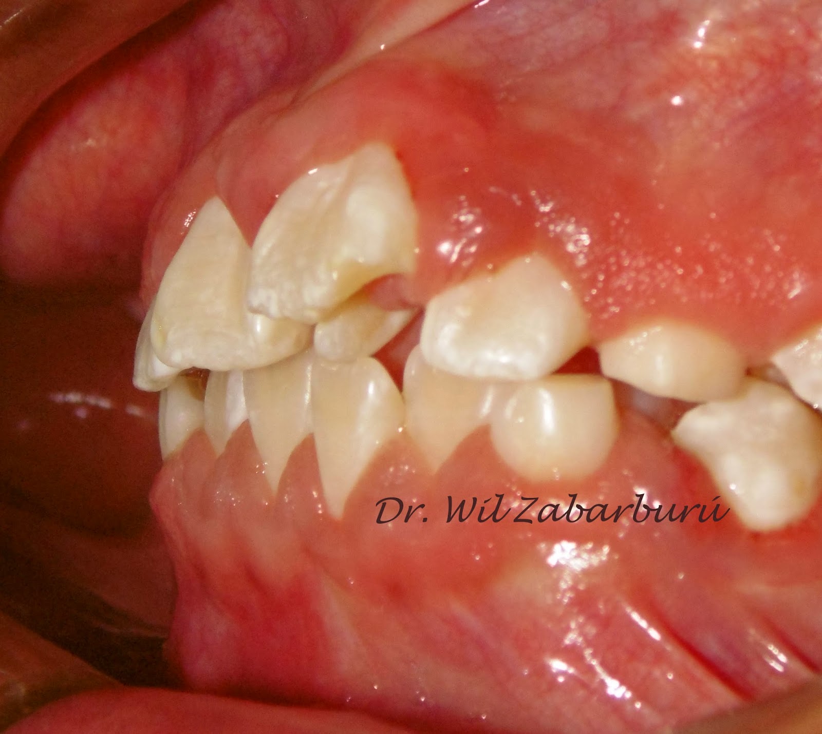 CLINICA DENTAL ASISTENCIAL: TALÓN CUSPÍDEO