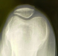 Estudo Radiográfico : ROTINA DE PATELA