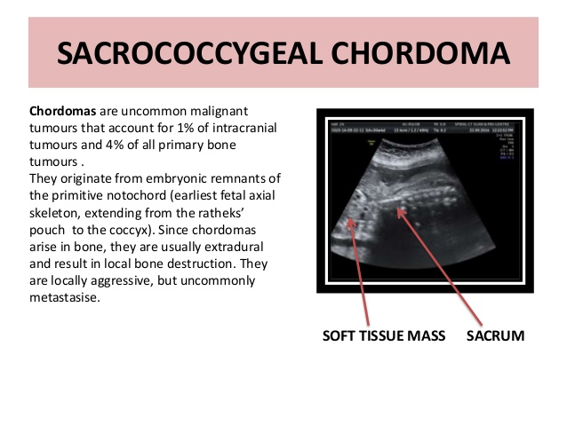 Chordoma