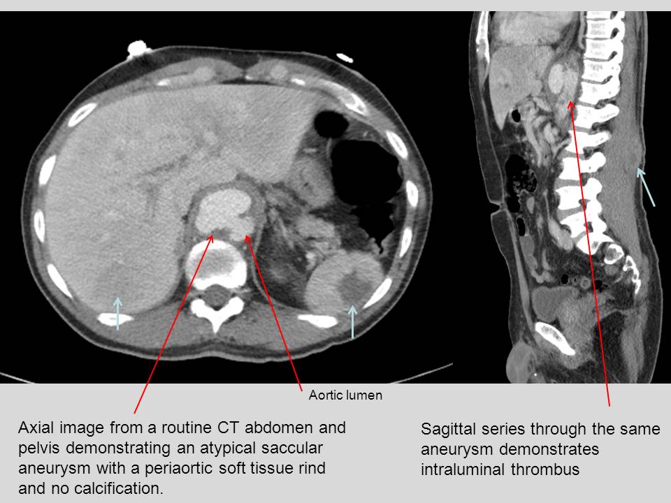 The Pump and the Tubes: The Bugs Burst Out -- Mycotic Aneurysm