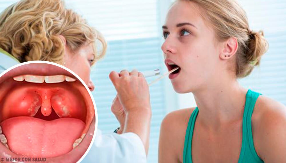 AMIGDALITIS AGUDA: EL PEOR ENEMIGO DE LOS NIÑOS PAUTEÑOS