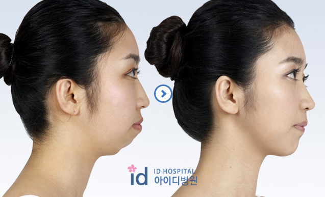 ID Hospital Korea: [ID Hospital- Best plastic surgery hospital in Korea ...