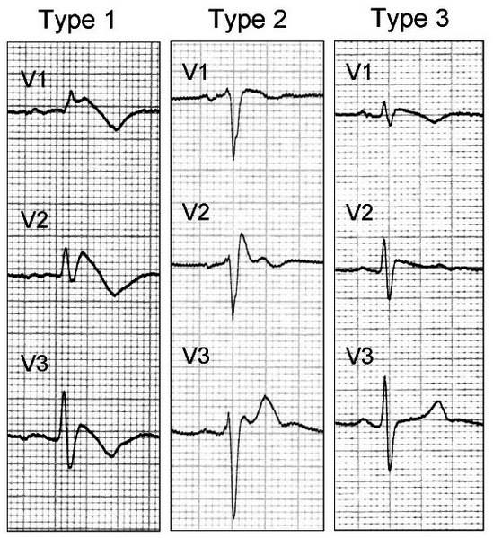 Sindrome Brugada INFO: SindromeDeBrugada