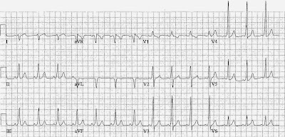 ECG of the Week: ECG of the Week - 28th October 2013 - Interpretation