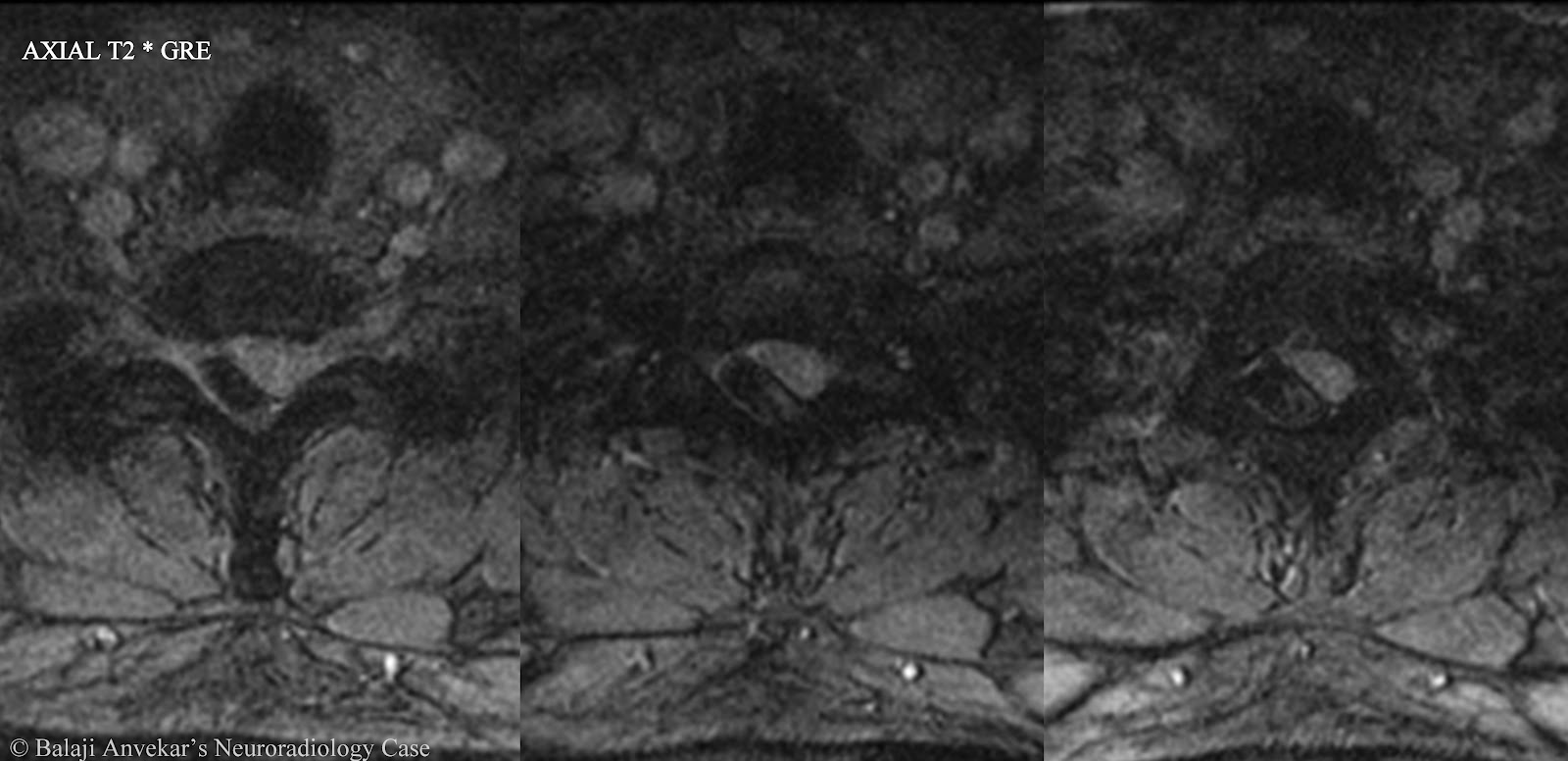 Dr Balaji Anvekar Frcr Spinal Epidural Hematoma Mri