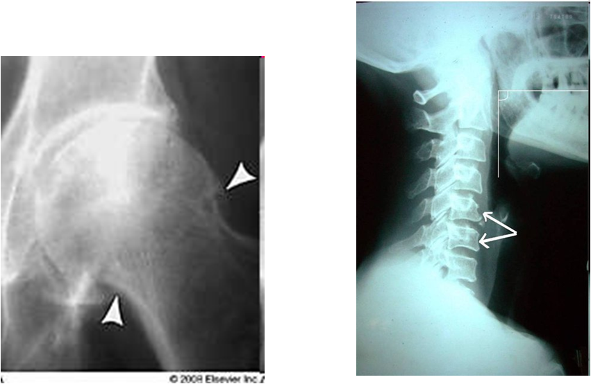Dentistry and Medicine: Osteoarthritis