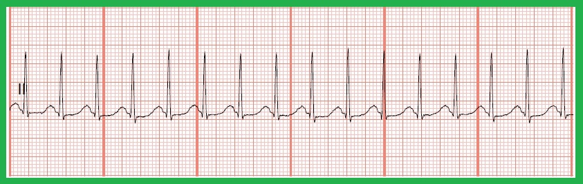 EKG Rhythm Strip Quiz 150