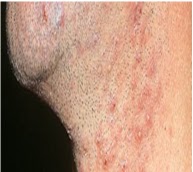 Referat Naya: Referat Ilmu Penyakit Kulit dan Kelamin : Ektima