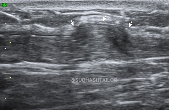 SONO DIGEST: ULTRASOUND EVALUATION OF MUSCLE HERNIA