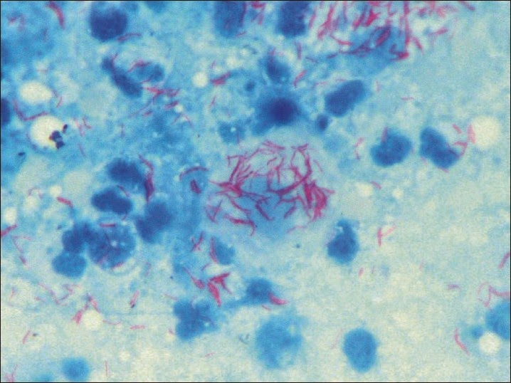 TUBERCULOSIS: Diagnóstico de la tuberculosis