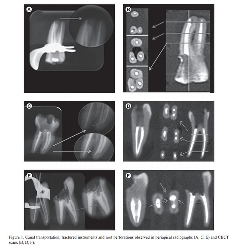 PDF: Procedural errors during root canal preparation using rotary NiTi ...