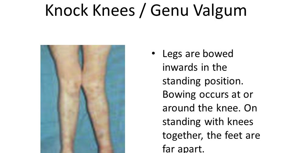Genu Valgum