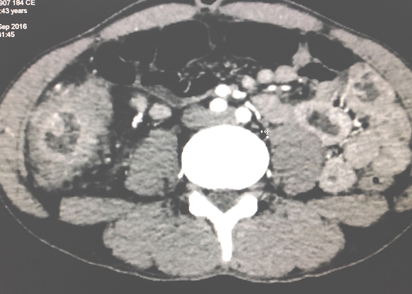 VIETNAMESE MEDIC ULTRASOUND: CASE 394: COLON TUBERCULOSIS, Dr PHAN ...
