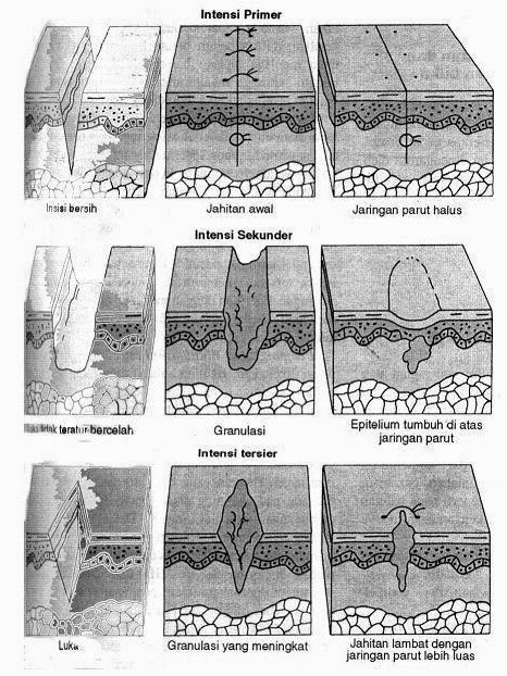 Gambar 2. Proses penyembuhan luka primer, sekunder, dan tersier
