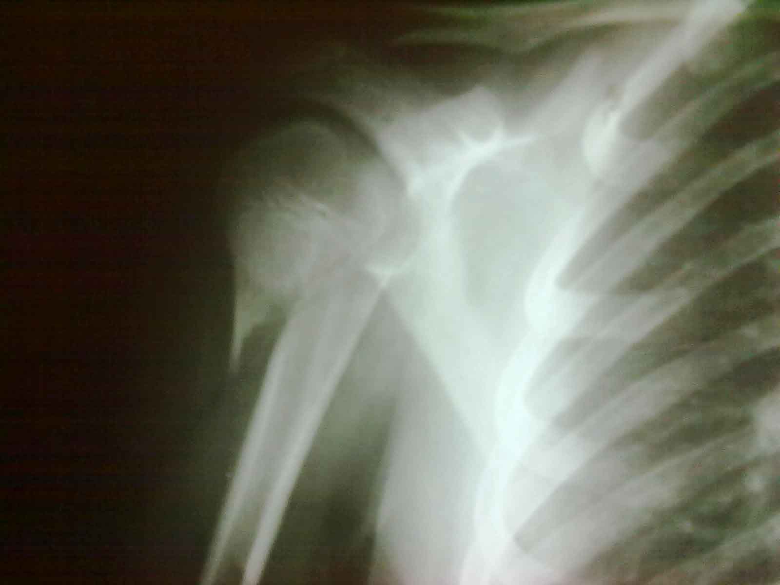 O R T O C R I T I C A: Caso Mensual II Marzo: Fx humero proximal no ...