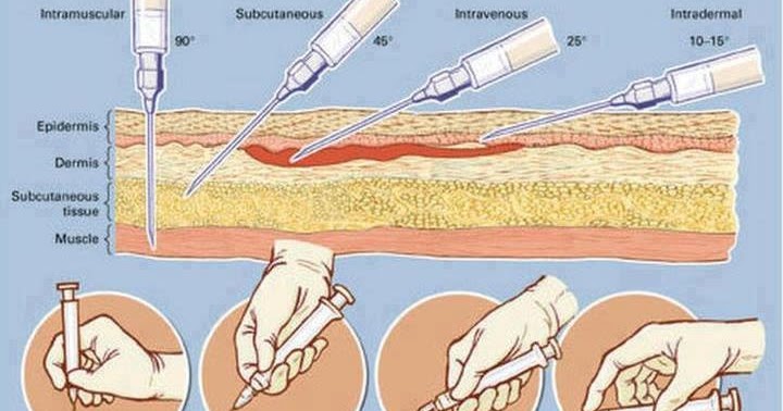 Aprende de una manera fácil los diferentes tipos de Inyecciones ...