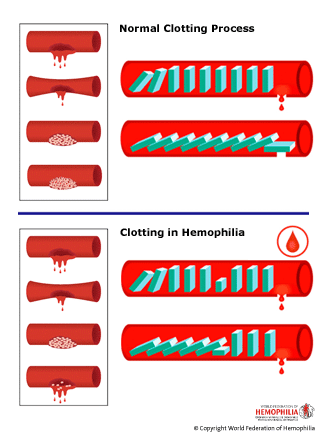 Haemophilia and Blood