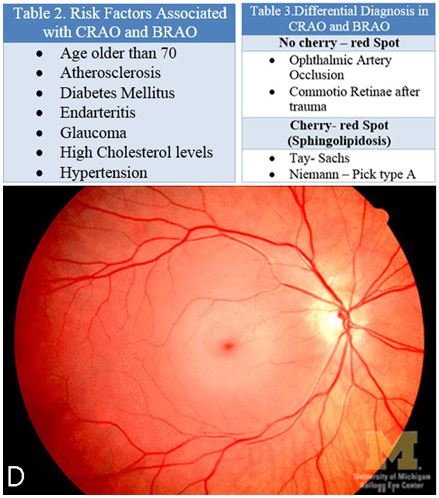 Ocular Emergency: Retinal Artery Occlusion (RAO), A Non-Ophthalmologist ...