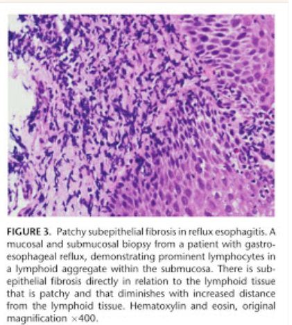 Atlas virtual de histologia e patologia: [CC II: #5] DOENÇA DO REFLUXO ...