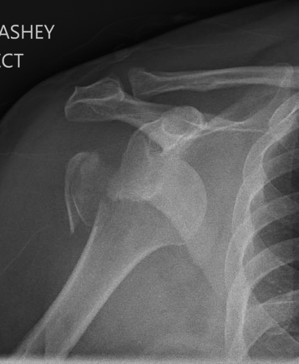 Shoulder and Elbow Surgery: Proximal humerus fracture dislocation - Do ...