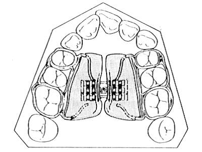 ODONTO-ESTOMATOLOGICA: APARATO DISYUNTOR HIRAX