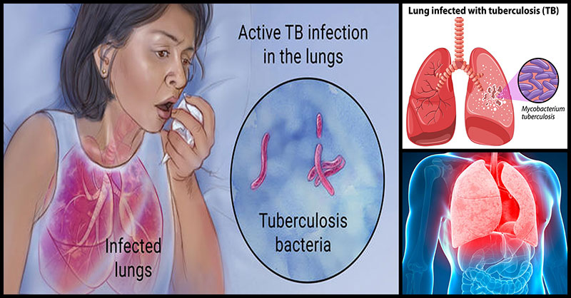 Effective Home Remedies For Tuberculosis | Dr Farrah MD